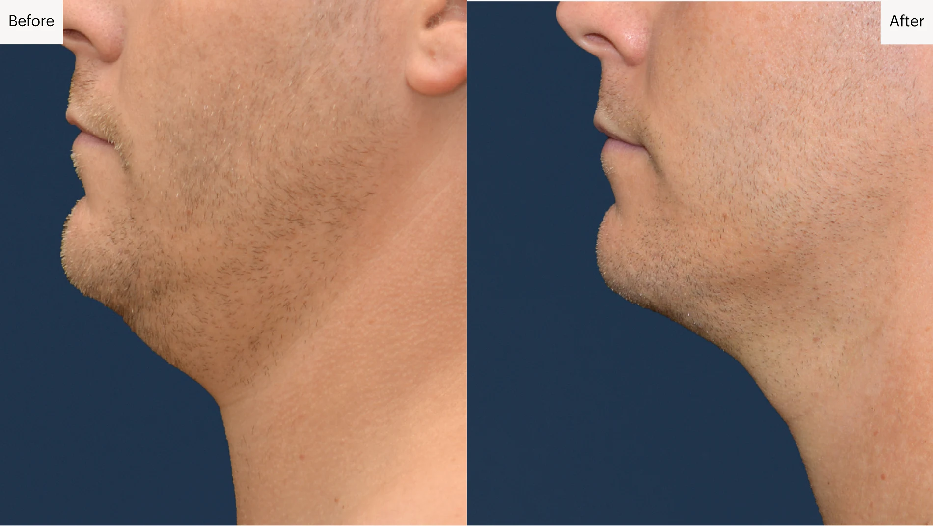 Coolsculpting Chin Before And After
